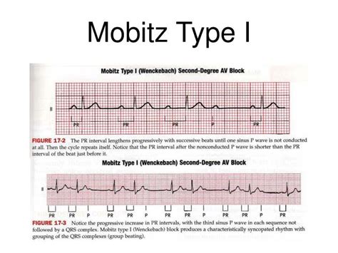 Ppt Atrioventricular Av Heart Block Powerpoint Presentation Id 613537