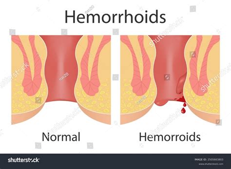 Comparison Anatomy Normal Hemorrhoidal Disease Anus Stock Vector