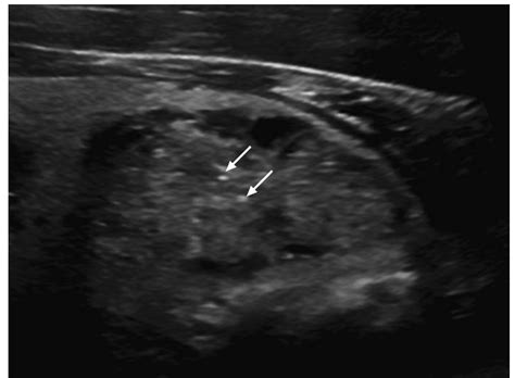 Ultrasound Image Of A Benign Nodule Nodular Hyperplasia