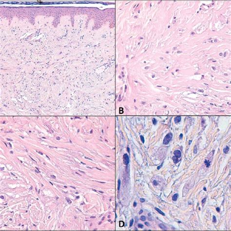 Scanning View Showing The Polypoid Lesion With The Associated Epidermal