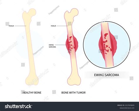 Osteochondroma Gross