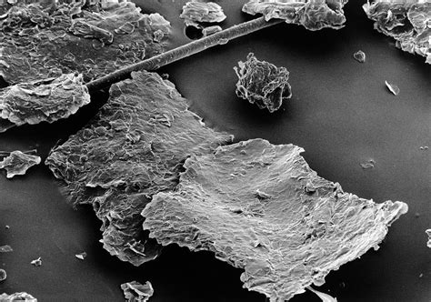 Sem Of Human Dandruff By Dr Jeremy Burgess Science Photo Library