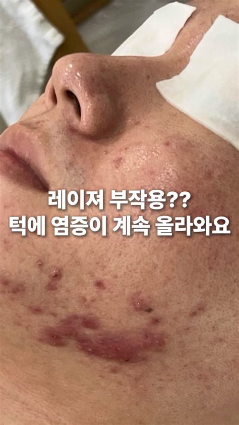 하이필스킨 구로 • 여의도 여드름 피부 관리 3월 이벤트 오픈🎉 무려 3가지 이벤트가 진행됩니다 공구이벤트 310 14 샵에서 판매하는 전 제품을 합리적인