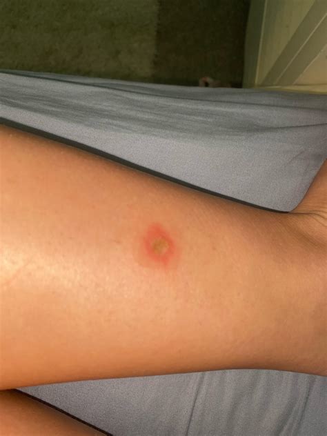 Infected Bug Bite R Dermatologyquestions