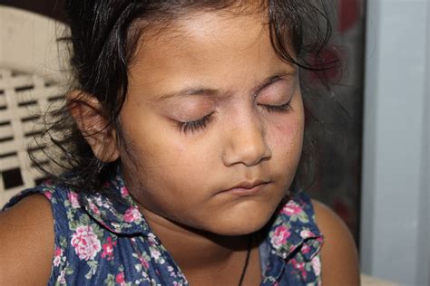 Full Recovery In Case Of Abcd Airborne Contact Dermatitis And