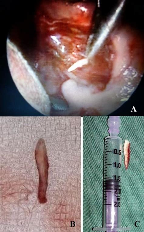 A Intraoperative Endoscopic Image Showing Excision Of Right Styloid Download Scientific