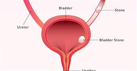 Bladder Stones Symptoms Causes Prevention Optimists Healthcare