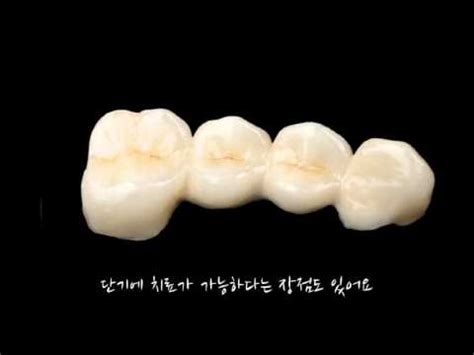 치아 브릿지 YouTube