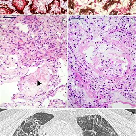 Histology And Radiology Of Mid Phase Dad Pattern A Ck7 And Mallory Download Scientific Diagram