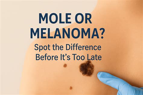 Mole Or Melanoma Spot The Difference Before Its Too Late Perfect
