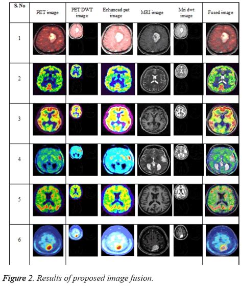 brain tumour detection using discrete wavelet transform based medical