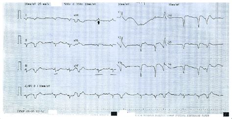 The Arrows Show The Main Wave Direction Of QRS In Lead AVR Was Positive Download Scientific