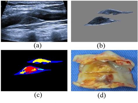 Figure 1 From Hru Net A Transfer Learning Method For Carotid Artery Plaque Segmentation In