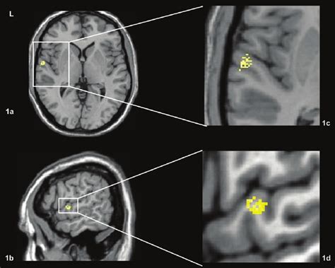 Time Points By Group Interaction Analysis Statistical Parametric