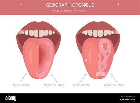 Geographic Tongue Disease Oral Medicine Medical Infographic Design