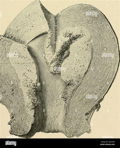 The Diagnosis And Treatment Of Diseases Of Women Fig 358 A Single