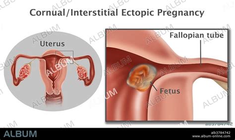 Cornual Ectopic Pregnancy Cornual Interstitial Pregnancy Album