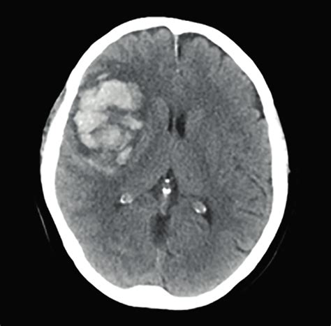 Figure Computed Tomography Scan Without Contrast That Shows A Right