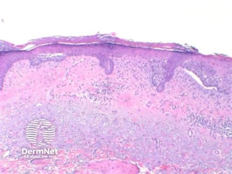 Superficial Basal Cell Carcinoma Histology Skin Cancer By Science