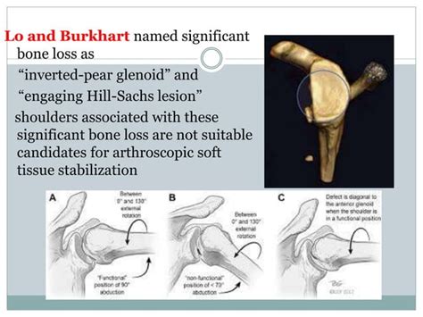 Assessment Of Glenoid Bone Loss In Recurrent Shoulder Dislocation Pptx