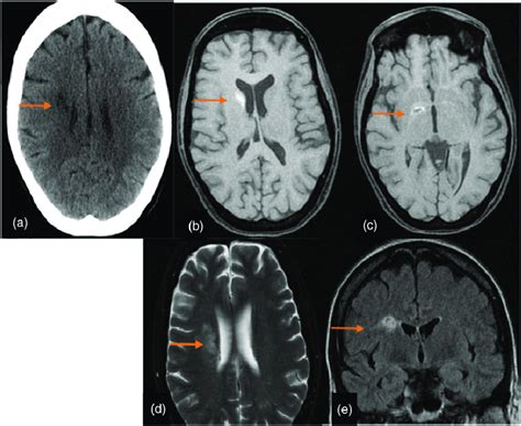 Cryptococcal Cns Infection A 41 Year Old Woman With Primary Pulmonary Download Scientific