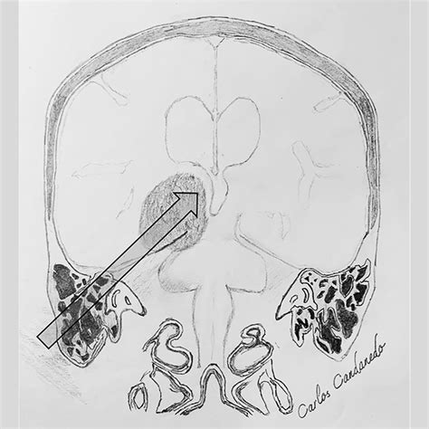 The Infratranstentorial Subtemporal Approach Itsta A Valuable Skull