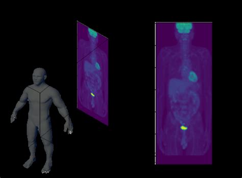 Maximum Intensity Projection Mip Download Scientific Diagram