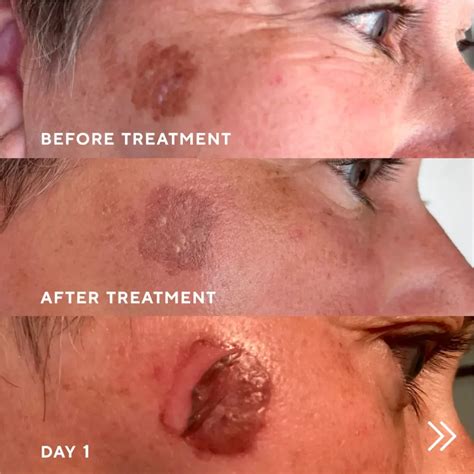 Cryotherapy In Gorleston Wart Skin Tag And Lesion Removal