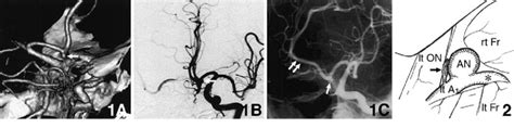 Three Dimensional Computed Tomography Angiogram A Showing An Azygos