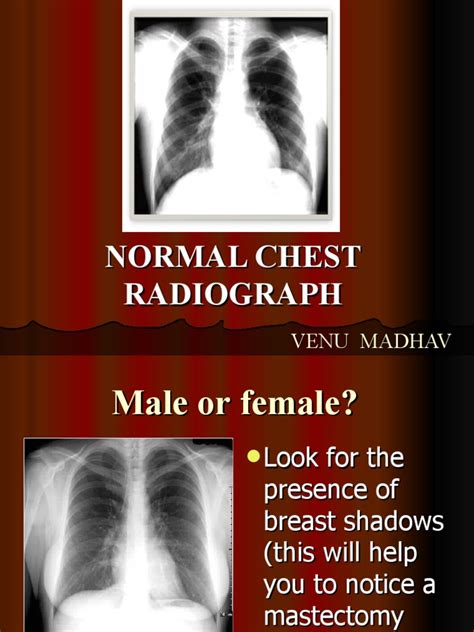 Normal Chest Radiograph Pdf Lung Radiography