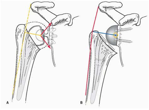 Reverse Shoulder Arthroplasty In The Management Of Glenohumeral