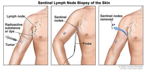Swollen Armpit Lymph Nodes Cancer