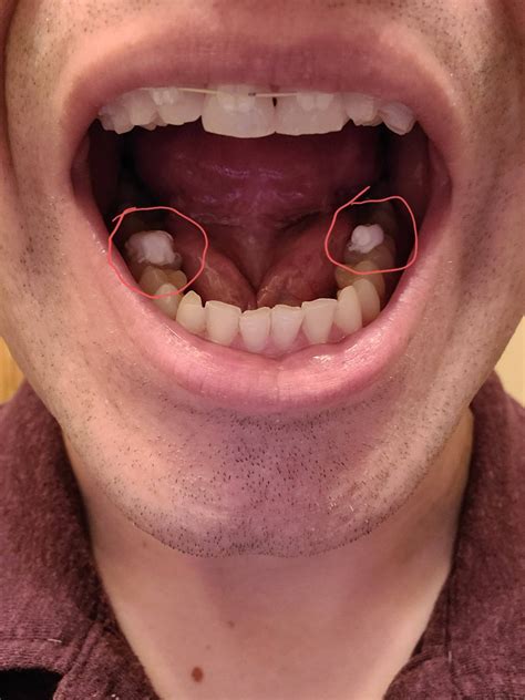 Huge Amounts Of Dental Cement Leaves Me No Ability To Eat What Do I Do R Braces