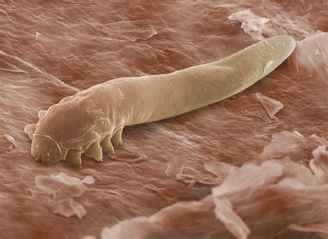 დემოდეკოზი მიზეზები სიმპტომები მკურნალობა