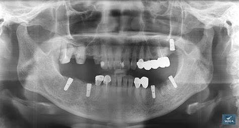 상아치과 신 님 임플란트 본 케이스는 5개의 임플란트 수술로 12개의 치아를 복원한 수술입니다