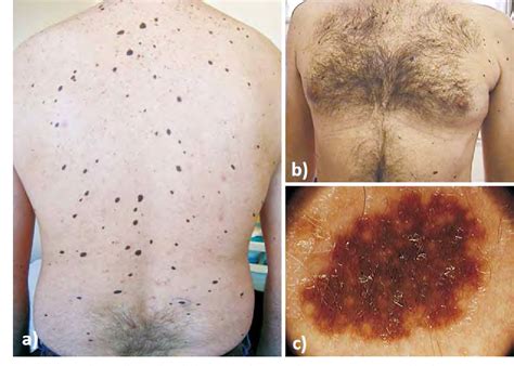 Figure 1 From Fast And Simultaneous Growth Of Multiple Melanocytic Nevi Associated With Seminoma