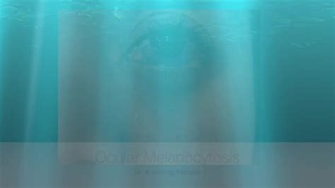 Scleral Pigmentation For Ocular Melanocytosis Mohammad Ghoreishi