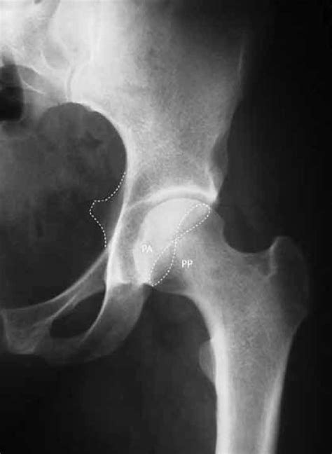 Anteroposterior Radiograph Of The Left Hip In Which Acetabular Download Scientific Diagram