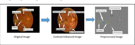 Table 1 From Experimenting Diabetic Retinopathy Classification Using Retinal Images Semantic