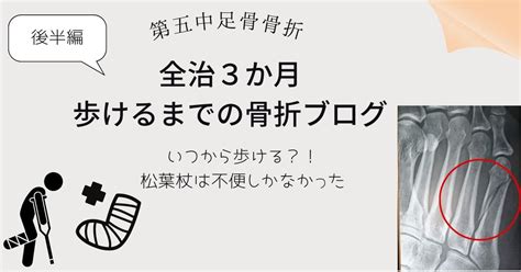 【体験談】第五中足骨骨折の経過日記～いつから歩ける？ギプスやシーネが外れて完治するまで｜松葉杖は不便しかなかった