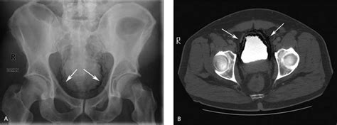 Emphysematous Cystitis A 50 Year Old Diabetic Man With Klebsiella Download Scientific Diagram