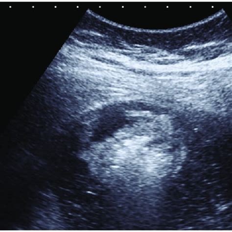 Ultrasound Demonstrating Gradual Resolution Of The Acoustic Shadowing Download Scientific