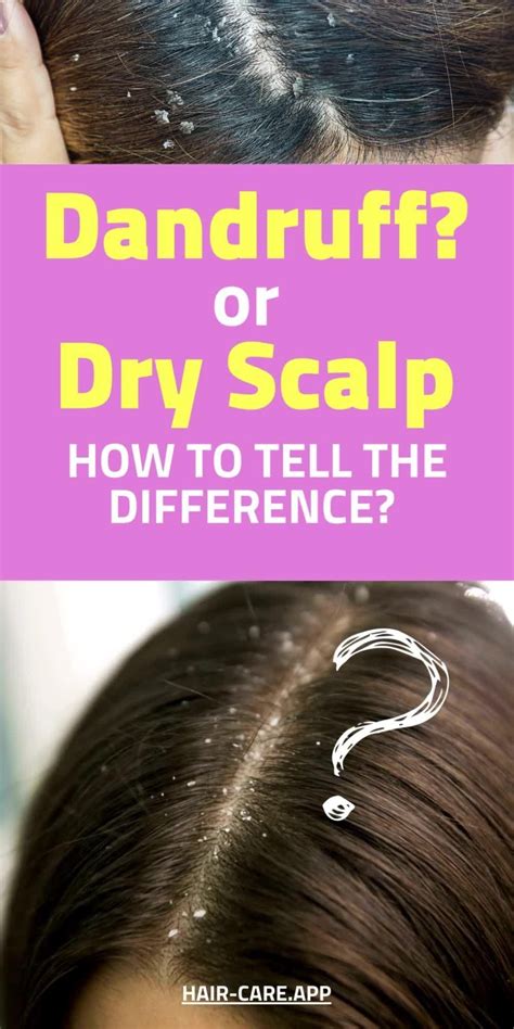 Dry Scalp Vs Dandruff The Itchy Dilemma Dry Scalp Dry Flaky Scalp Oils For Dandruff