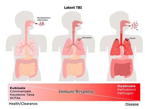 Host Associated Microbiome Factors In The Tb Spectrum Of Disease Tb