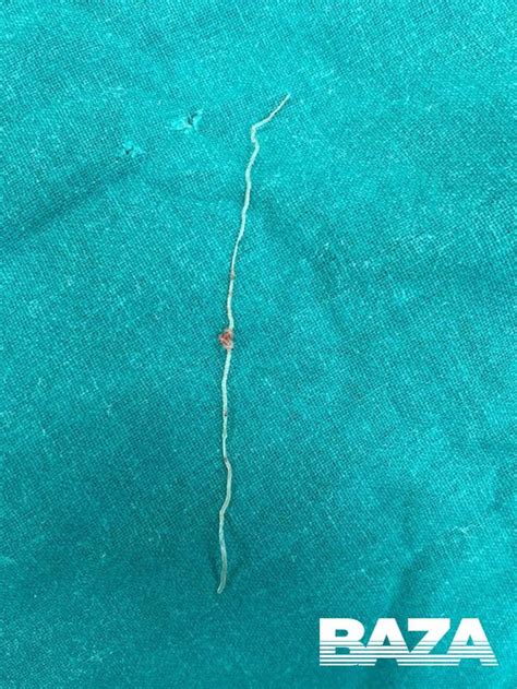 Həkimlər şiş Dedilər Qadının üzündən Qurd çıxdı 12 S