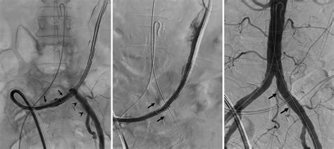 A Retrograde Pyelogram Through The Left Multi Side Hole Drain Download Scientific Diagram