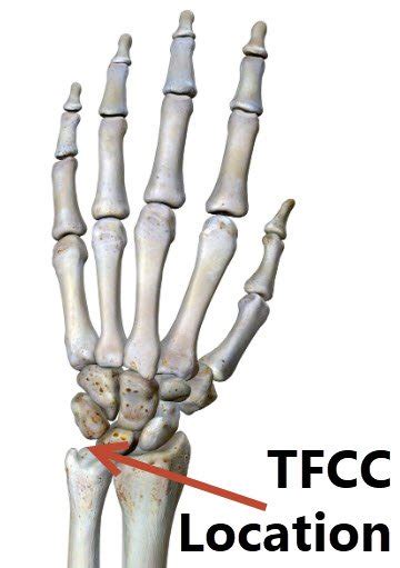 Tfcc Tear Joi Jacksonville Orthopaedic Institute