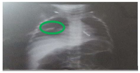 A Case Of Pneumonia Before Aspiration Patchy Opacity In Middle Part Of