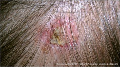 What You Need To Know About Skin Cancer On The Scalp Tita Tv Youtube