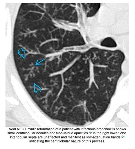 Tree In Bud Radiology Socorro Neel